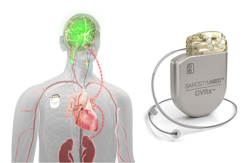 Barostim Therapy: Revolutionizing Hypertension Treatment - Medical ...