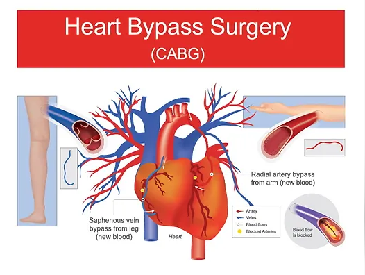 Bypass: Medical Procedures, And Benefits - Medical Device Registry