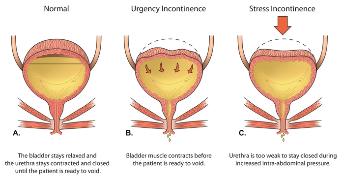 Urinary Incontinence: Causes, Symptoms, And Treatment Options