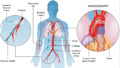 Angiography - Procedure, Risks, And Benefits | Patient9.com