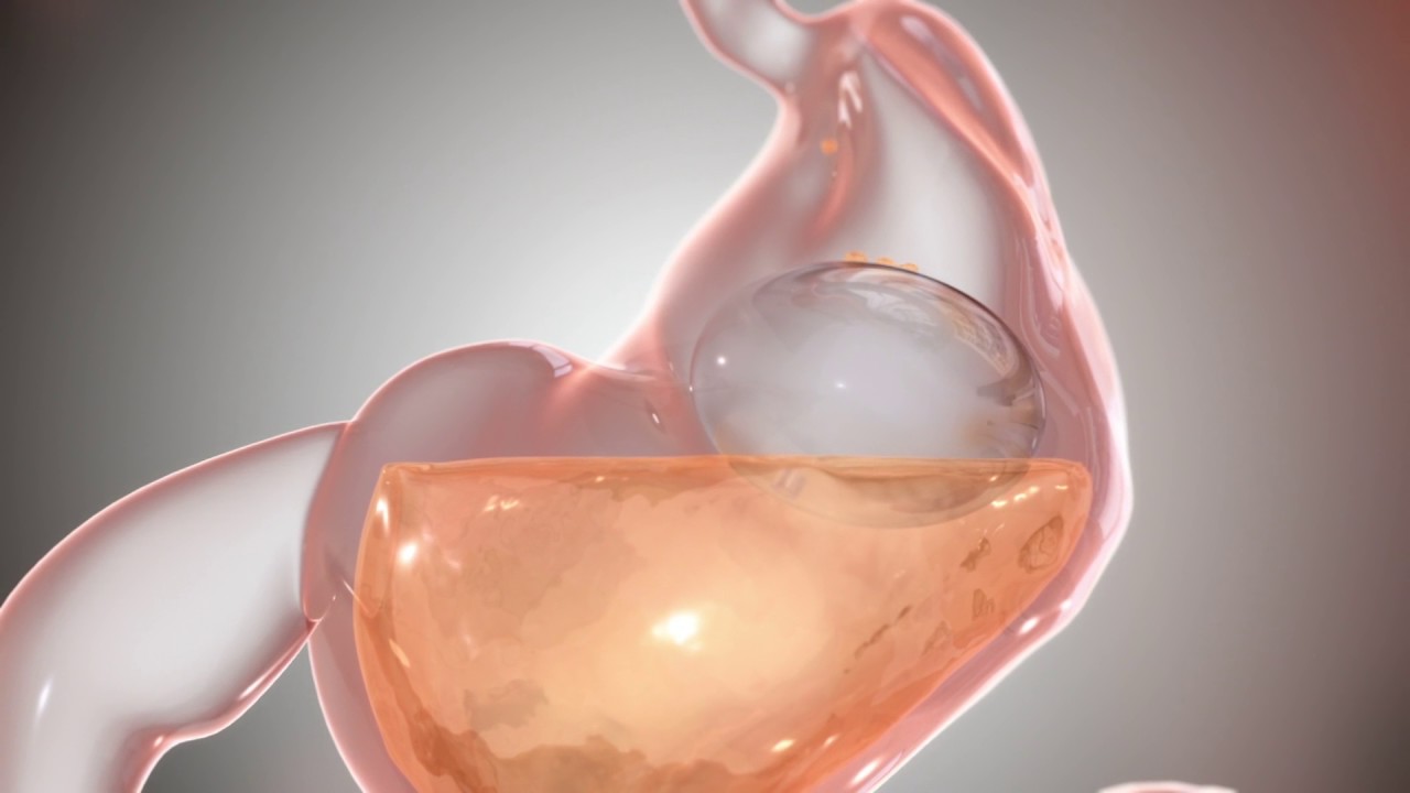 Obalon Gastric Balloon For Non-Surgical Weight Loss | Patient9.com