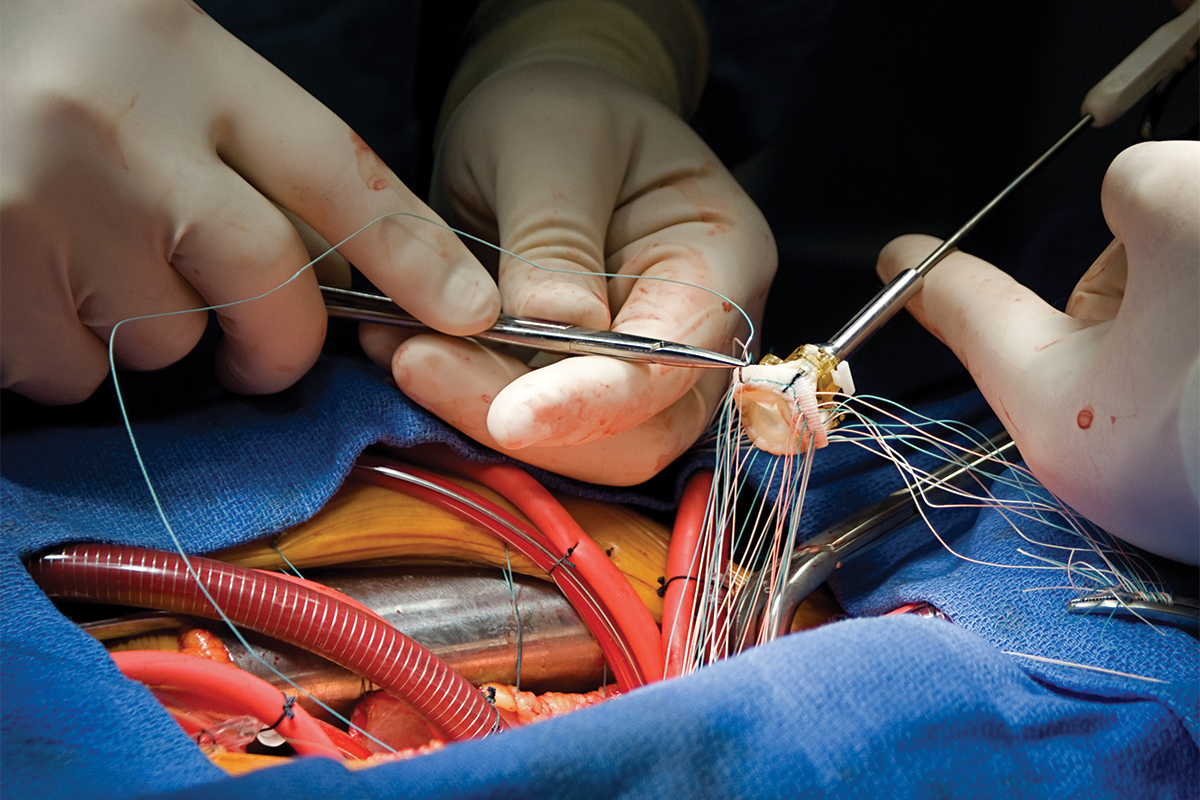 Surgical Aortic Valve Replacement (SAVR) | Patient9.com