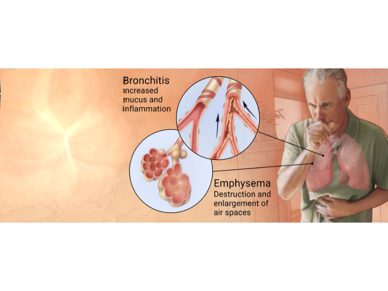 Emphysema: Breathe Freely Again With Our Expert Insights!