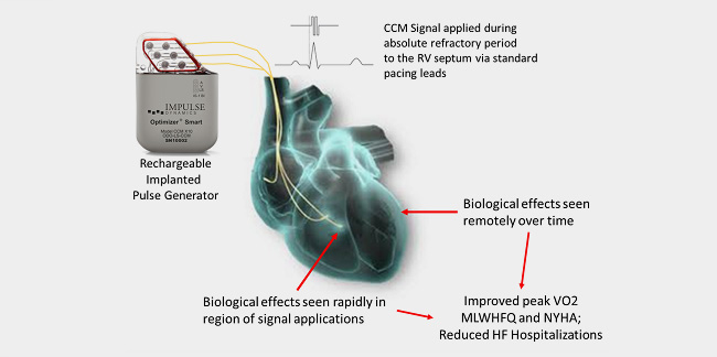 Cardiac Contractility Modulation: Innovative Heart Failure Treatment