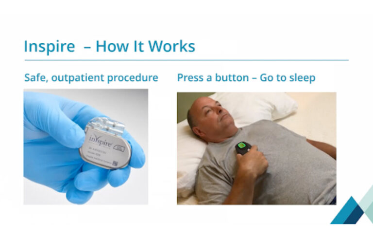Inspire Sleep Apnea Device Review & Treatment Benefits - Medical Device ...